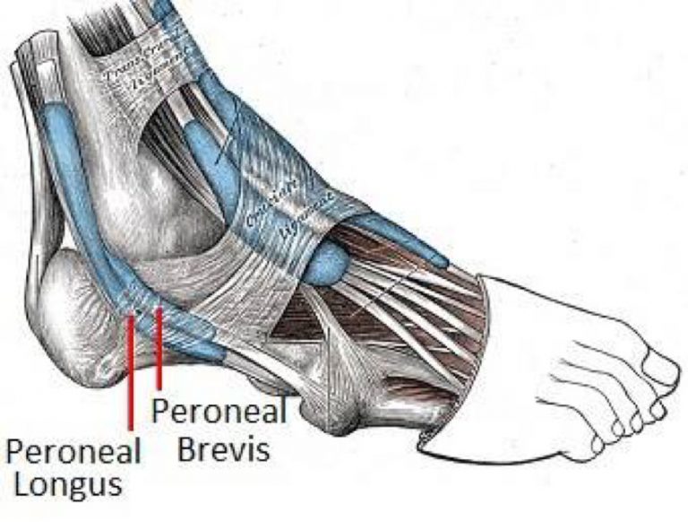 peroneal-tendon-injury-with-ganglion-cyst - Ballarat OSM
